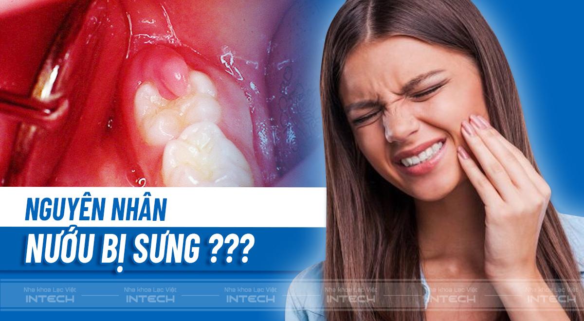 Bỏ túi 7 nguyên nhân sưng nướu răng mà bạn không thể bỏ qua