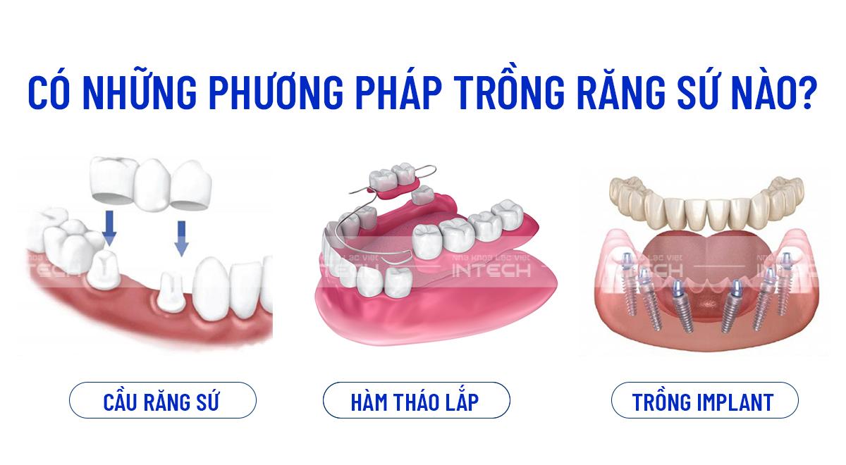 Có những phương pháp trồng răng sứ nào? Trồng răng sứ ở đâu?