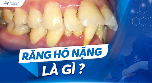 Răng hô nặng là gì? Các phương pháp điều trị răng vẩu nặng