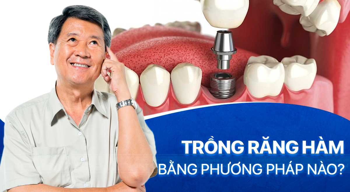 Trồng răng hàm nên chọn phương pháp nào tốt nhất? Ảnh hưởng mất răng hàm?